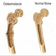 KNOWLEDGE: OSTEOMALASIA DAN RAKITIS