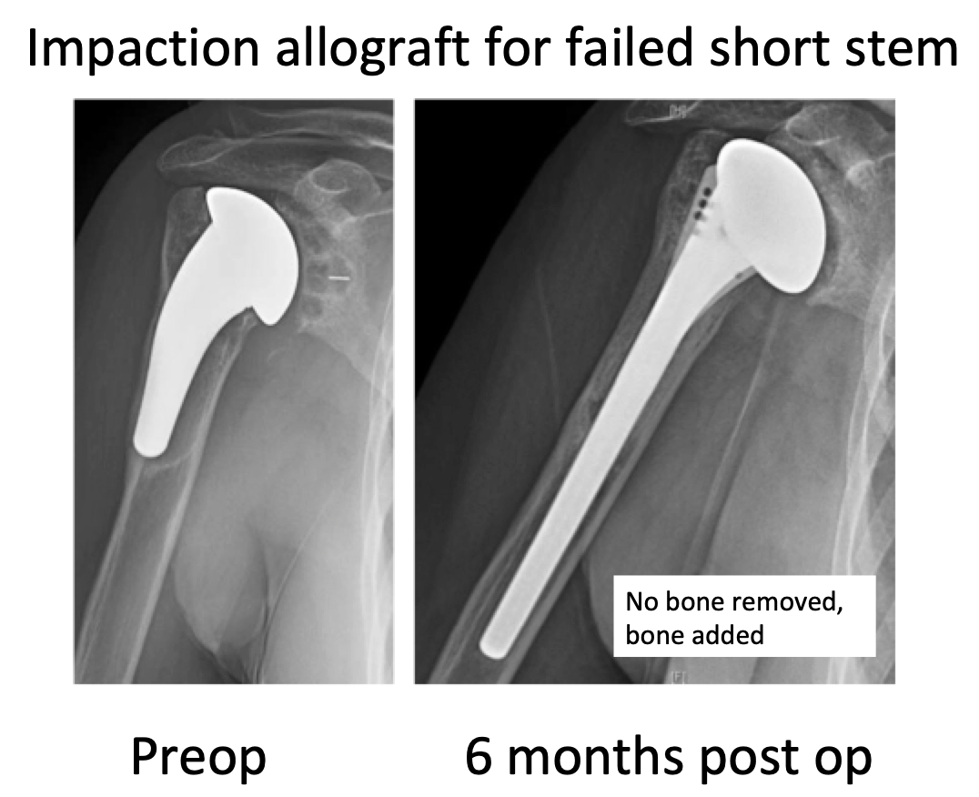 UW Shoulder and Elbow Academy: Are short stems of value in total ...