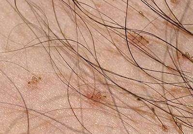 El profesor Bigotini: EVOLUCIÓN PARALELA: PIOJOS Y LADILLAS, AMIGOS ...