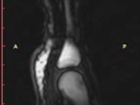 Dynamic MRI of a Knuckle Cracking - Radiology Imaging