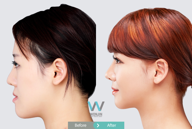 Perbedaan antara operasi dua rahang dan rahang? Operasi apa yang cocok ...