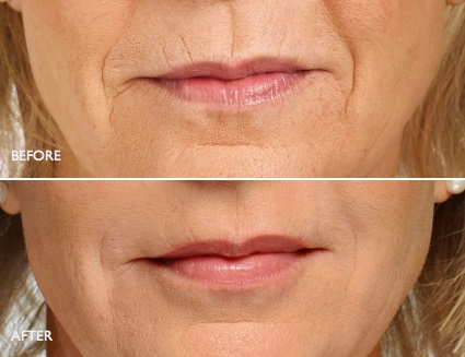Selston Cosmetic Clinic: Erase Smokers Lip Lines With Dermal Filler ...