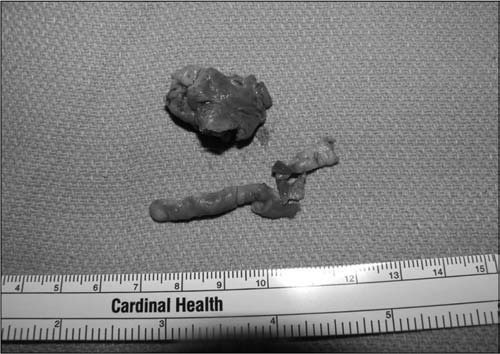 Infective Endocarditis Case File