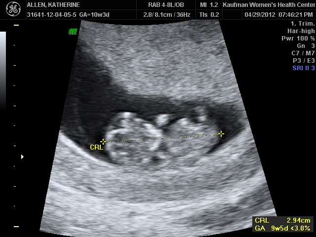 Allen Family News: 10 Week Sonogram Pics