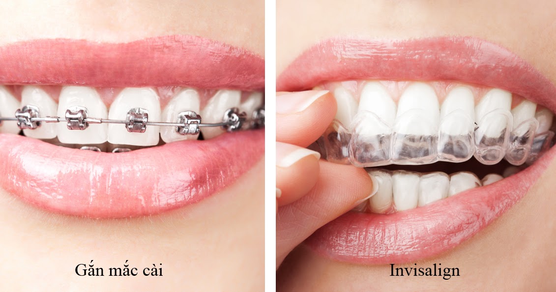 Chỉnh nha Invisalign | Minh Tuan Dentist