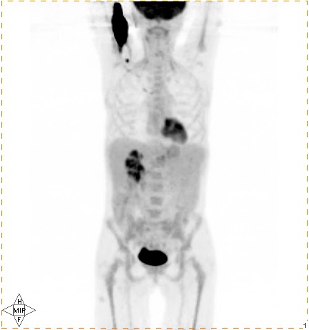 Nuclear Medicine Technology Program: Extravasation