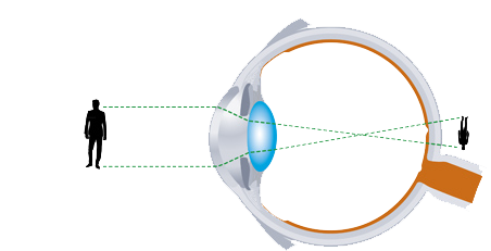 Types Of Hypermetropia