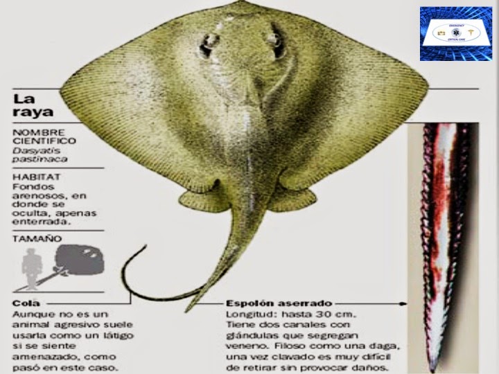 EmergenMed Health Blog: Necrosis cutánea severa por picadura de raya en ...