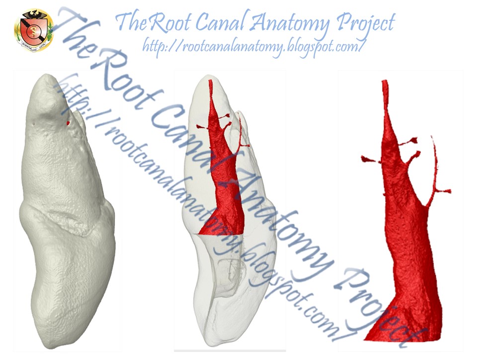 The Root Canal Anatomy Project: Two-Rooted Maxillary Central Incisor
