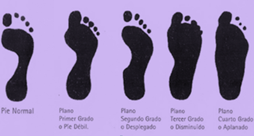 En el mismo sentido: PIE PLANO