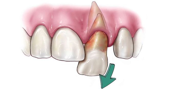 How to handle dental trauma? - OdontoVida
