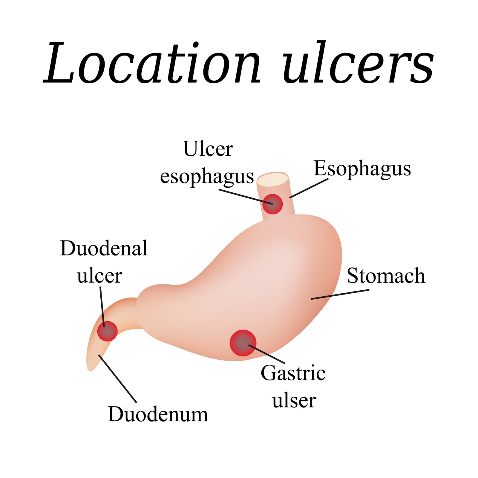 Gi Endoscopy Practice: Peptic Ulcer Disease
