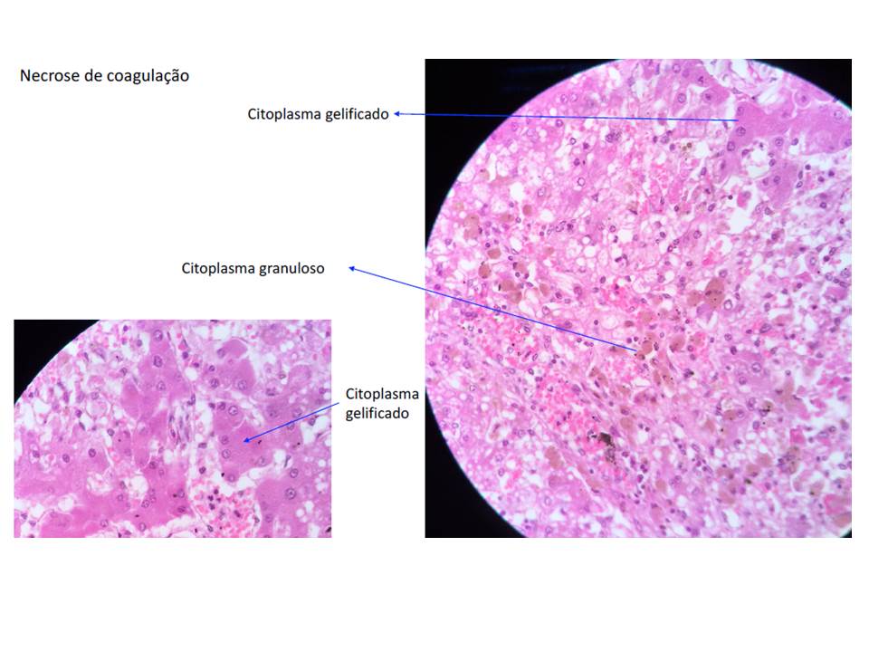 HISTOLOGIA90: TIPOS DE NECROSE