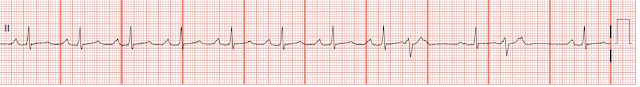 EKG Rhythm Strips 13- Heart Blocks