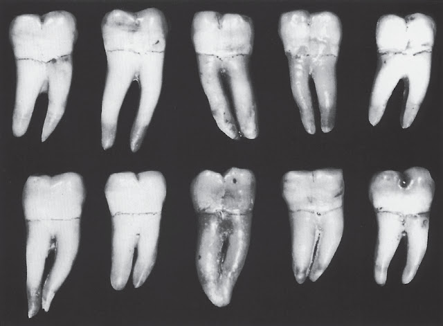 Dentosphere : World of Dentistry: Mandibular Second Molar - Curved root ...