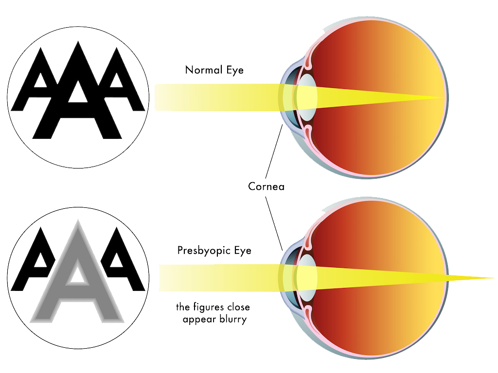 Presbyopia Refraction
