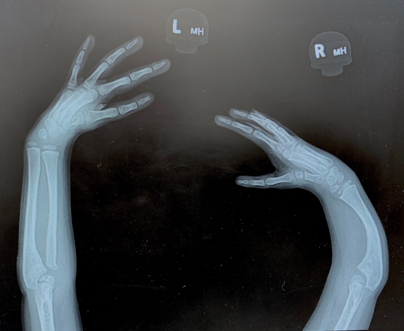 Radial Deficiency Outcome | Congenital Hand and Arm Differences ...
