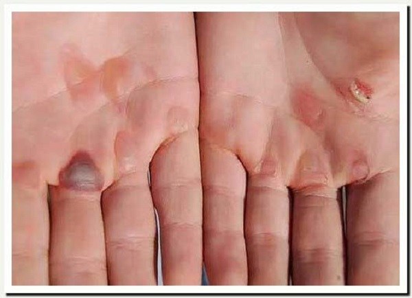 This Is How To Treat Ruptured Blisters And Remove Them Easily!