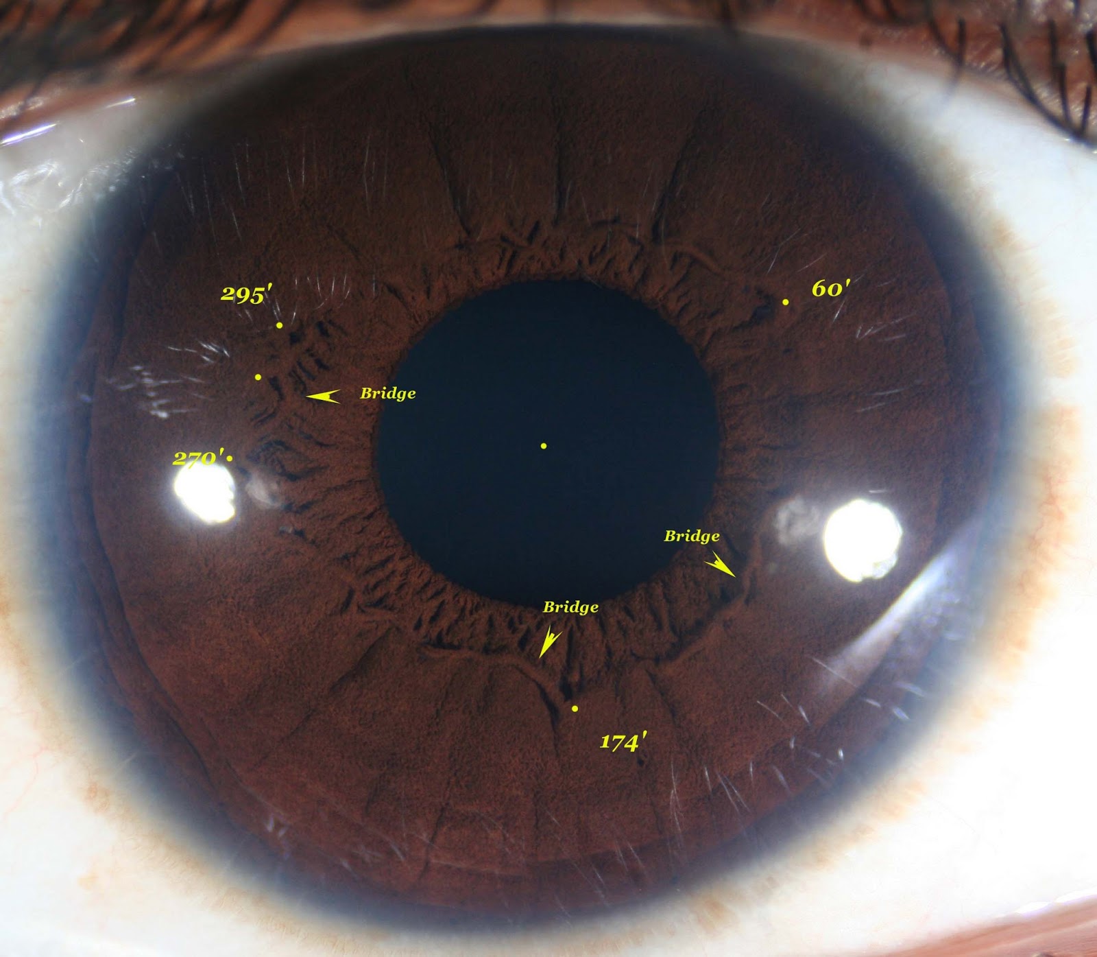 Modern & Multidimensional Iridology: Crypts at Internal Pupillary ...