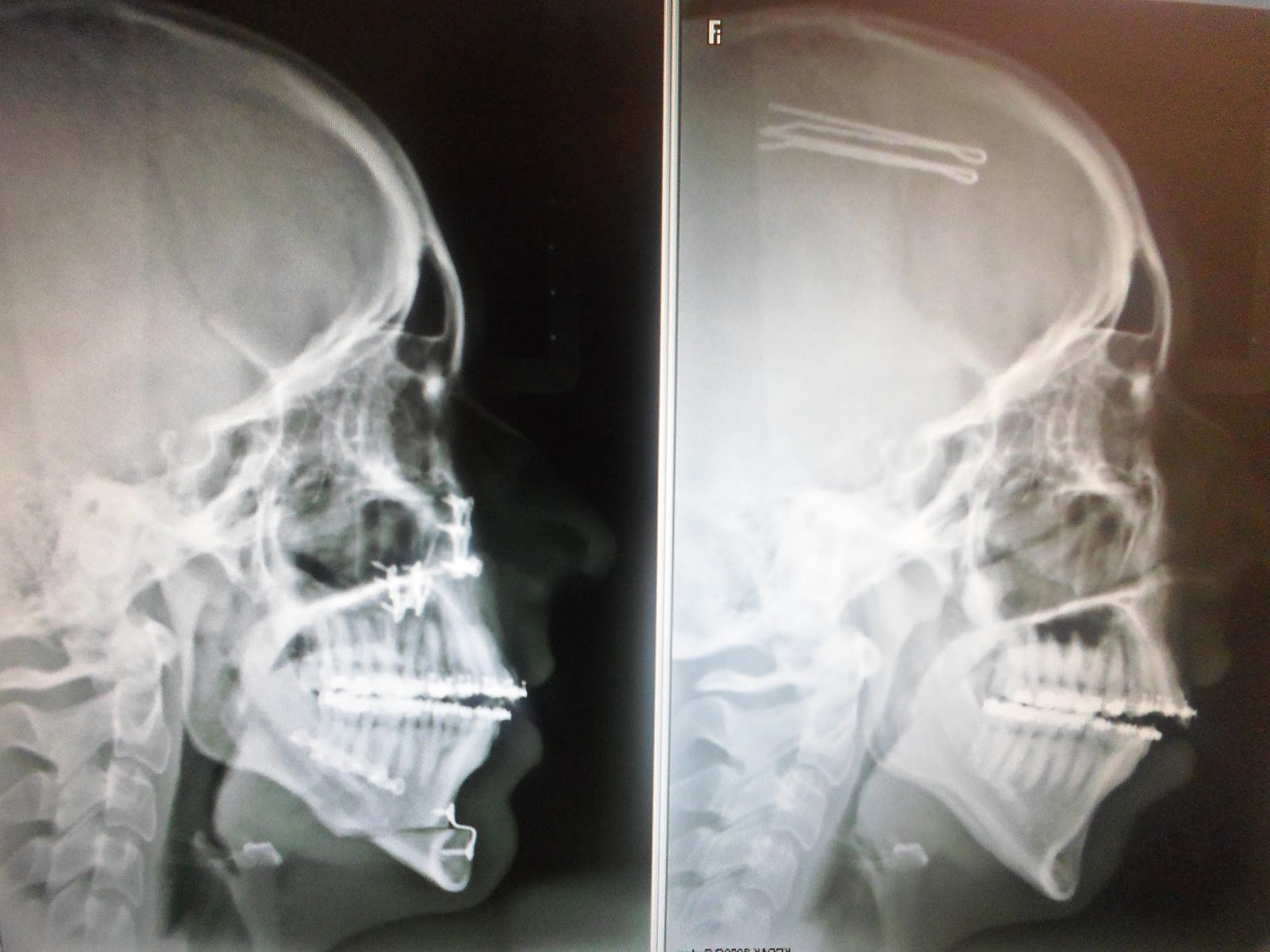 My jaw surgery and I..: Day 27: X-rays and surgeon visit