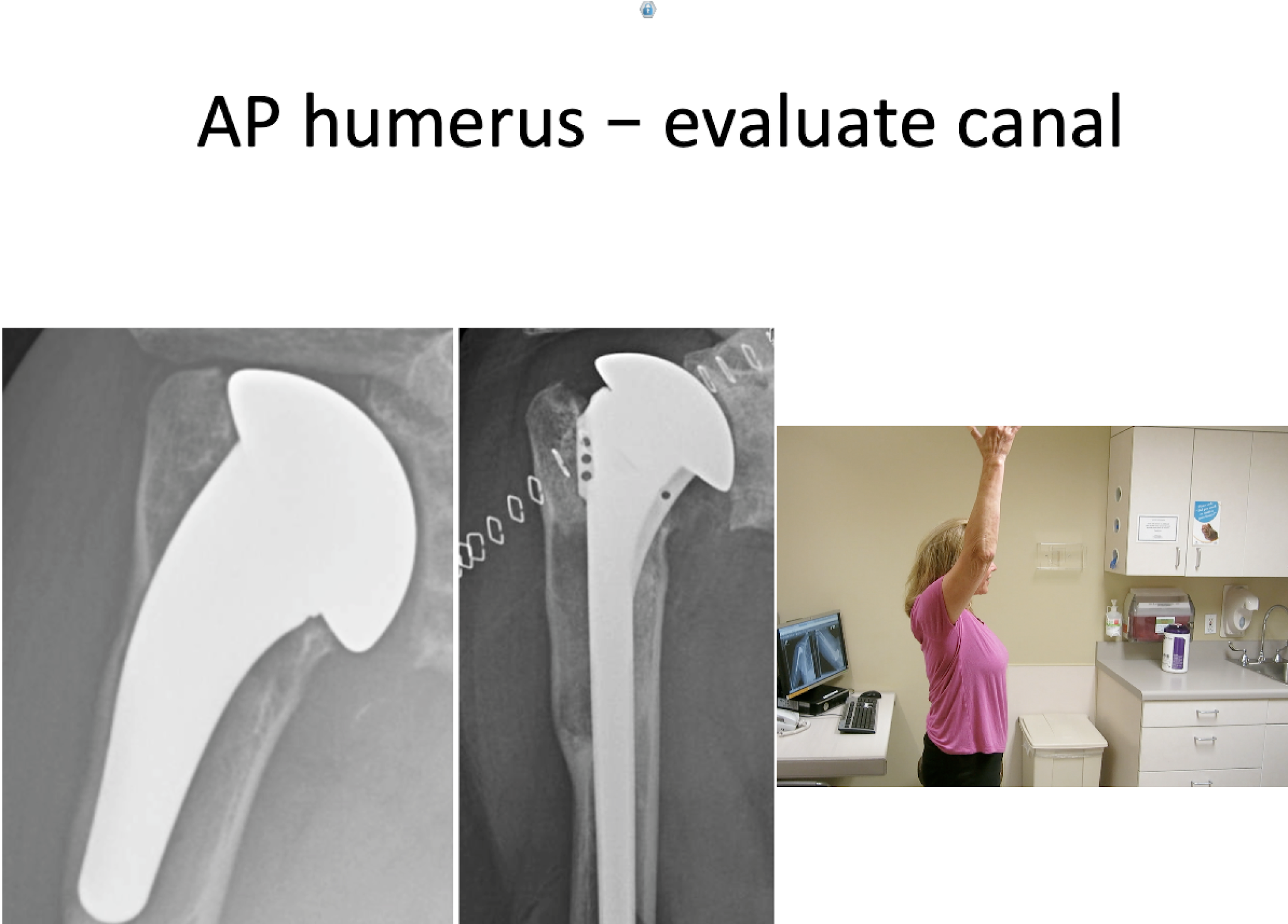 UW Shoulder and Elbow Academy: Ream and run - imaging the shoulder ...