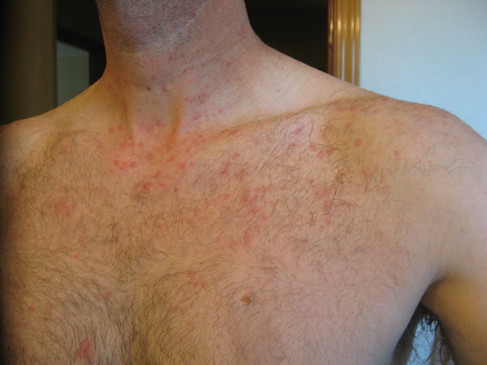 The Two R's: Running and Hay Fever