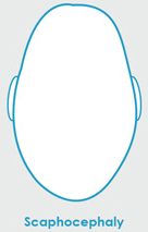My Little Head: What is Plagiocephaly?