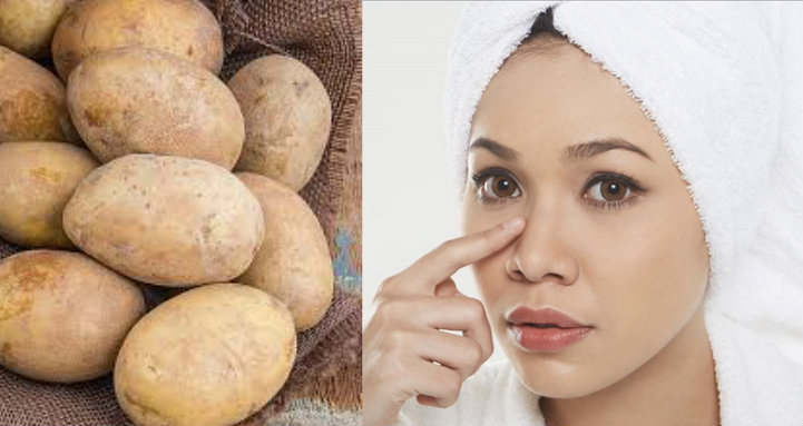 How To Use Potato To Treat Acne, Pimples and Scars Easily At Home Home ...