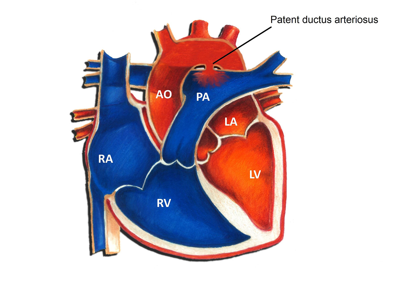 Patent Ductus Arteriosus Pda How To Guide Tips And Tricks