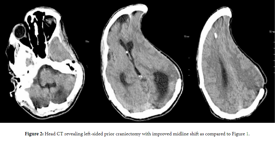 pediatric neurology: The sydrome of the trephined