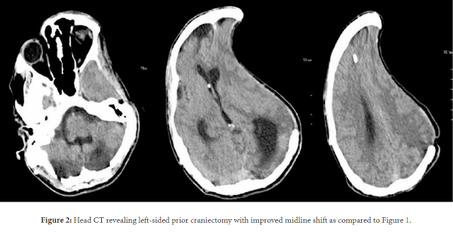 pediatric neurology: The sydrome of the trephined