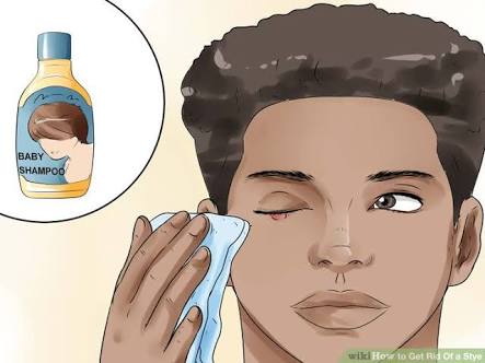 Optometrists: Stye and steps to treat stye