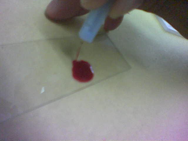 CLIN CHEM EXPLORER: What capillary puncture is and how it is performed