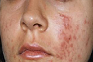 5 WORST ACNE MOST FEARED IN THE WORLD - HEALTH MAGAZINE
