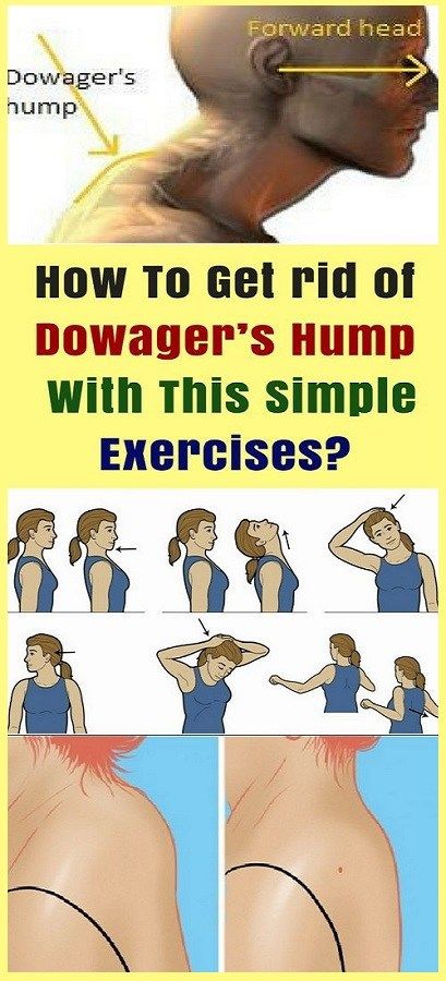 7 AIMS: How To Get rid of Dowager’s Hump With This Simple Exercises?