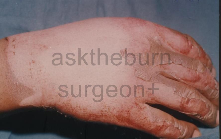 Ask The Burn Surgeon +For Free+: BURN PICTURES AND BURN VIDEOS.