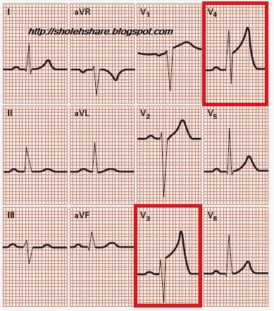 ST Elevasi Miokard Infark (STEMI) pada EKG | SholehShare