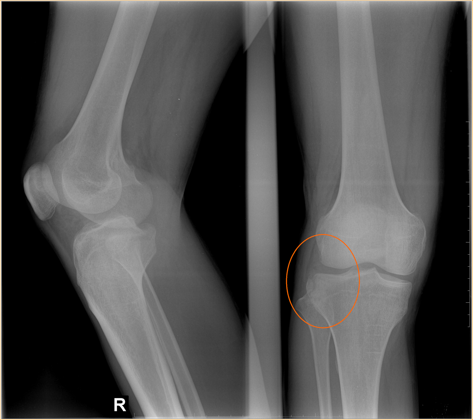Segond fracture of the proximal tibia - Sumer's Radiology Blog