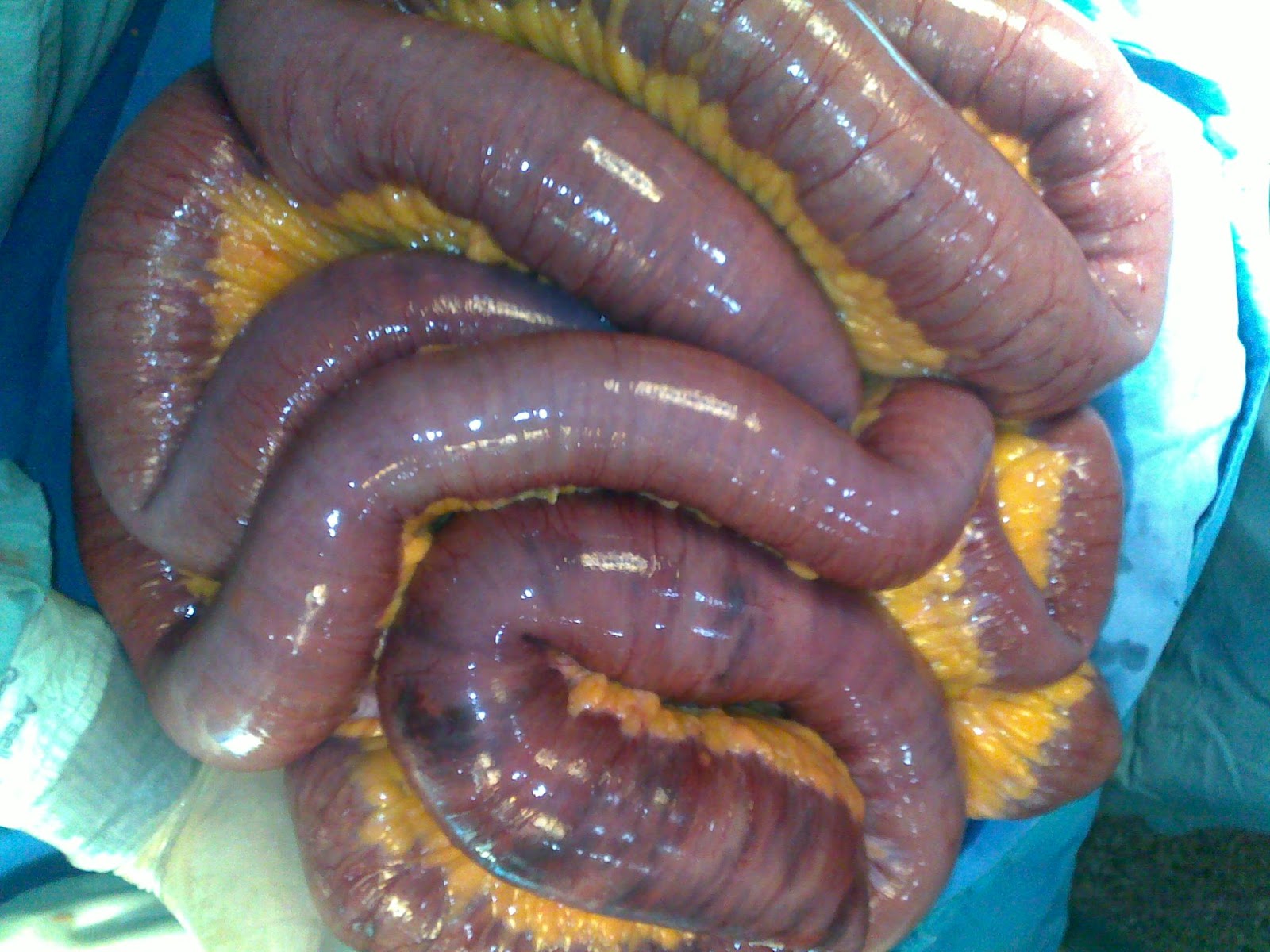 DR. KEYUR S. BHATT (MS, MRCSEd): CASE: Obstruction with bowel gangrene