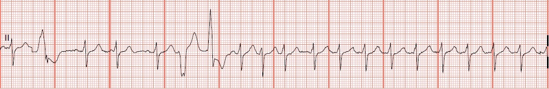 ECG Rhythm Strip Quiz 67