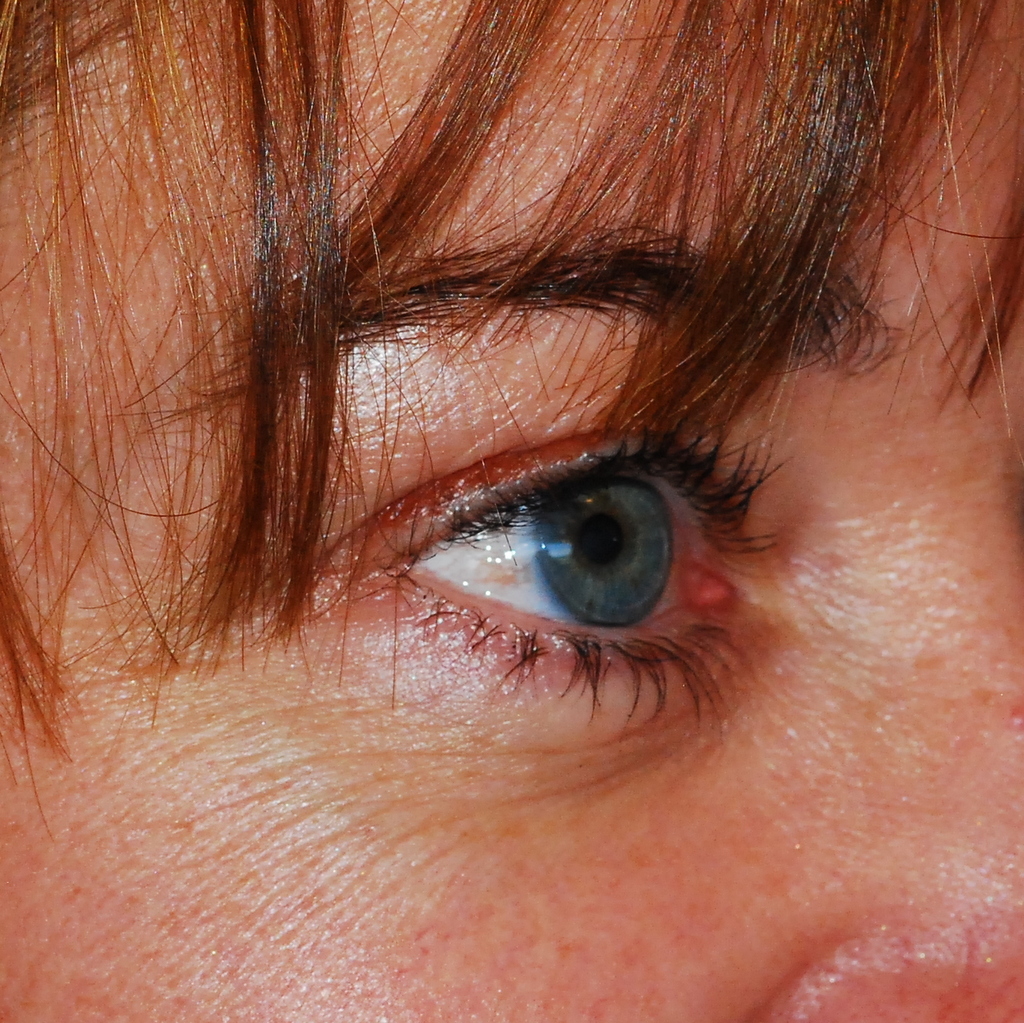 Stephen Weber, MD, FACS: Transconjunctival vs. Transcutaneous ...