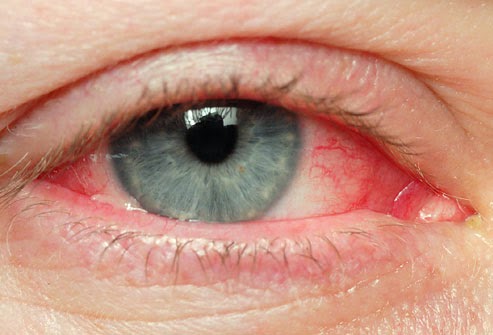 Health: Look about how long does pink eye last