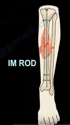 Dr. Nabil Ebraheim's Blogspot: Open Fractures of the Tibia