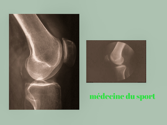 IMAGERIE DU GENOU APPLIQUÉE A LA PATHOLOGIE SPORTIVE