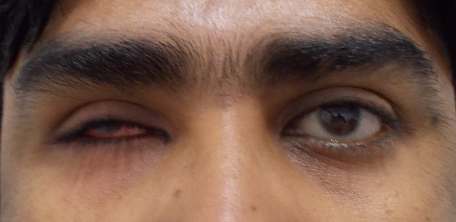 Ocularist in Kolkata: KARUNAMAYEE PROSTHETIC EYE CLINIC