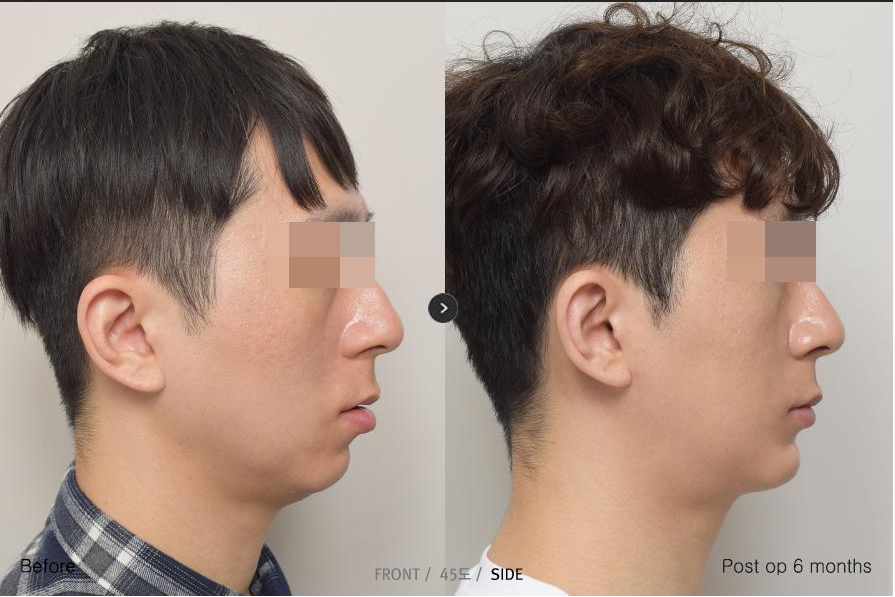 What is facial asymmetry? Can I improve with double jaw surgery?