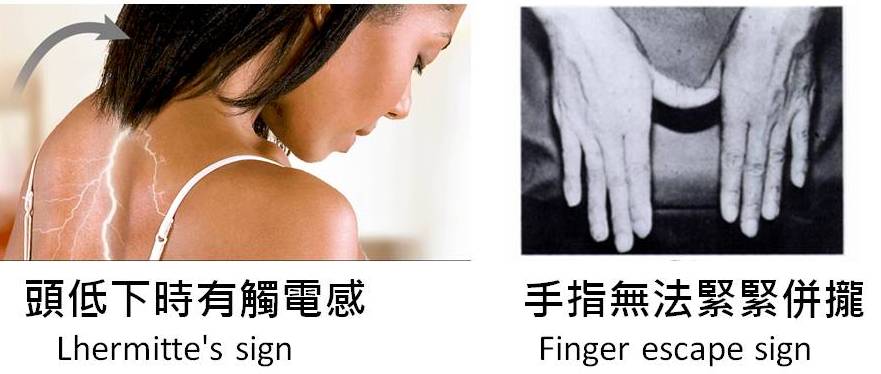 Finger Escape Sign