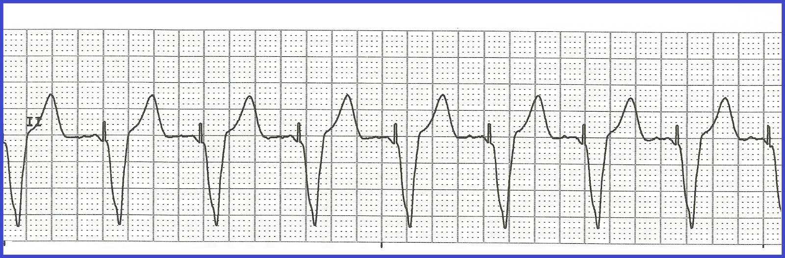 Basic EKG Rhythm Test 01