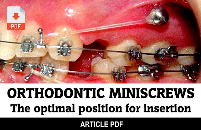PDF: The optimal position for insertion of Orthodontic Miniscrews