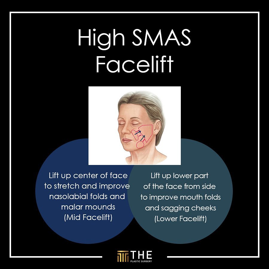 THE Plastic Surgery: What you need to know about High SMAS Facelift